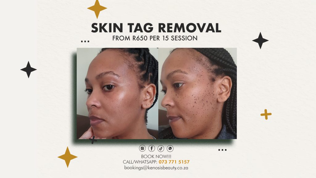 Skin Tag Removal Services | Kenosis Beauty Institute